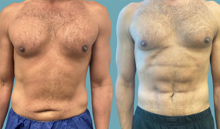Male Body Contouring Before & Afters - Evolve Plastic Surgery