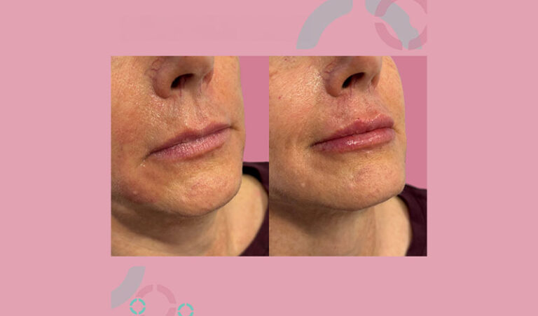 Facial Injectables Before & Afters - Evolve Plastic Surgery